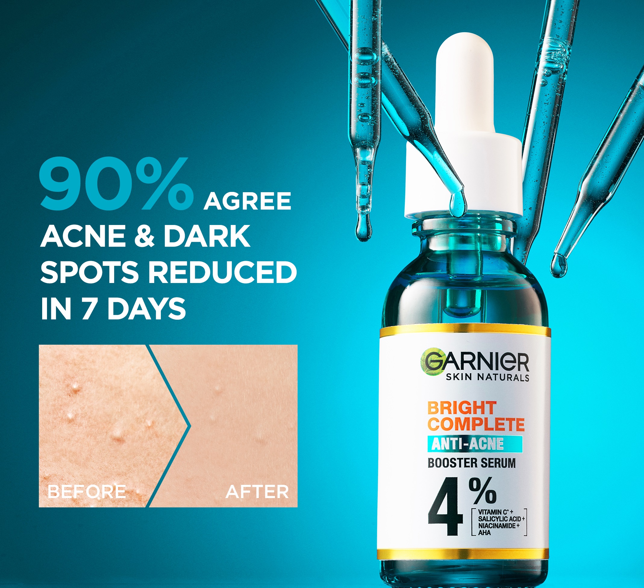 Garnier 4% Salicylic Acid Anti Acne Serum w/ Vitamin C, Niacinamide ...