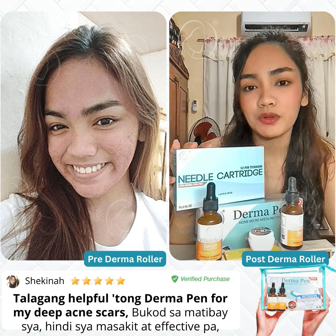 Derma Pen Original Home Microneedling Device by Derma Roller ...