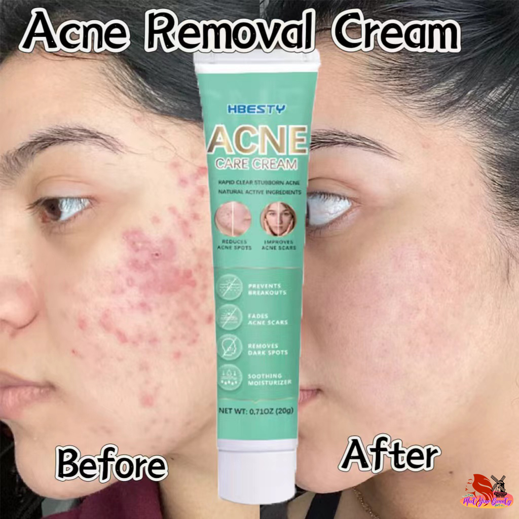 Acne Removal Cream Effective Remove Pimples Fades Acne Repairs Acne ...