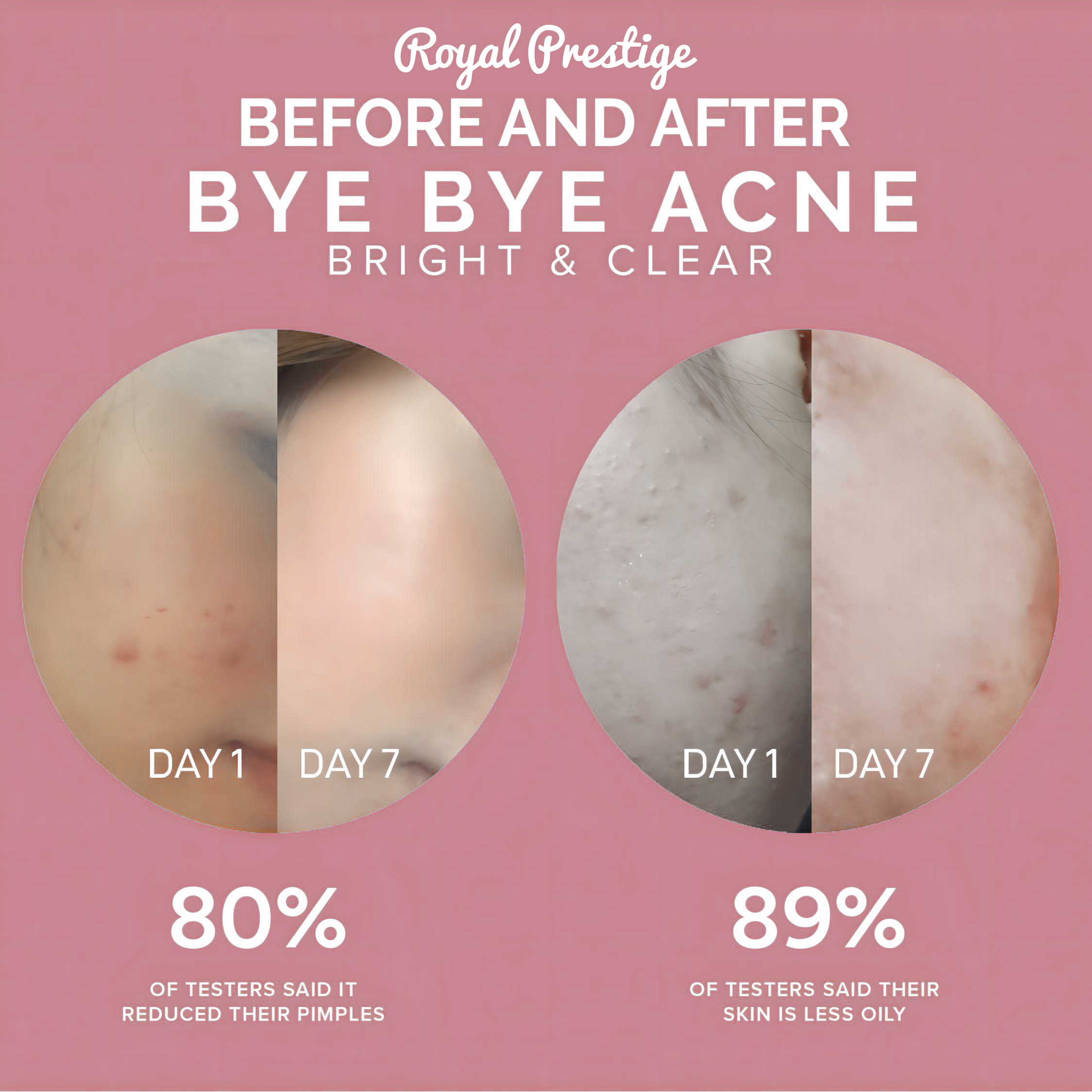 PINKFLASH 24 Hours Waterproof Invisible Ultra Thin Acne Patches for ...