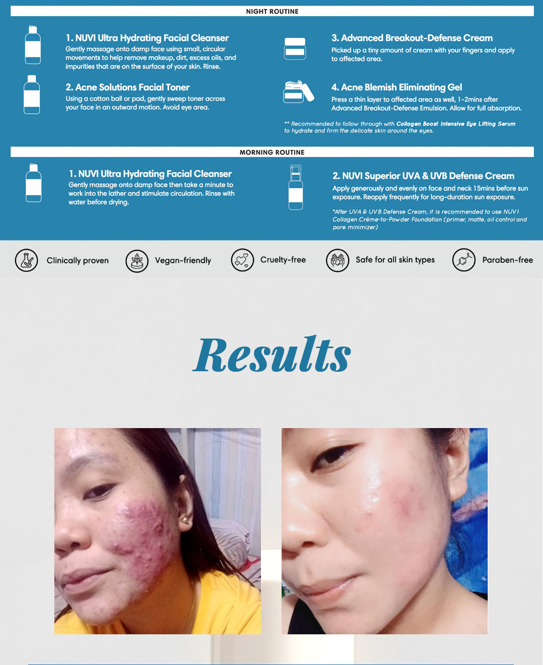 NUVI Multi-Active Acne Clearing Bundle [Acne Solution, Acne Remover, Acne Treatment, Pimple ...