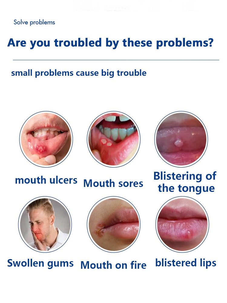 Canker sore spray 50ml mouth ulcer treatment Canker mouth sore solution ...