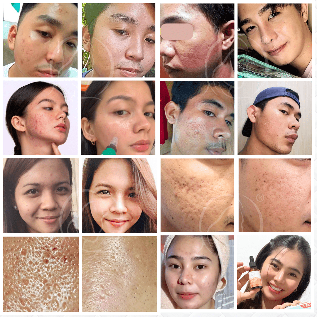 Derma Pen PACKAGE [PRO | MAX] by Derma Roller Philippines | Shopee ...