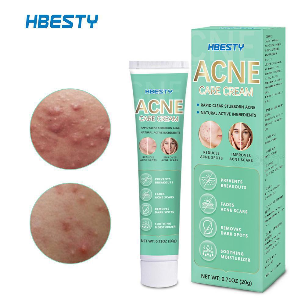 Acne Removal Cream Effective Remove Pimples Fades Acne Repairs Acne ...