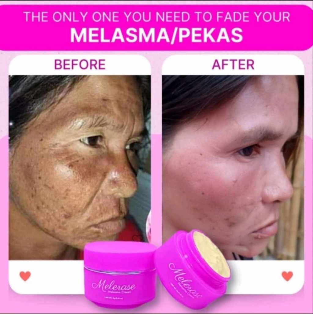 Belle Glow Melasma Duo new packaging - Mela-rase facial cream & Premium ...