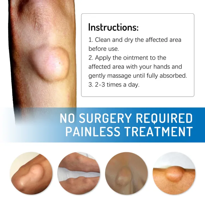 Lipoma Removal Spray Lipolysis Fat Lump Relief Plaster Skin Swelling ...