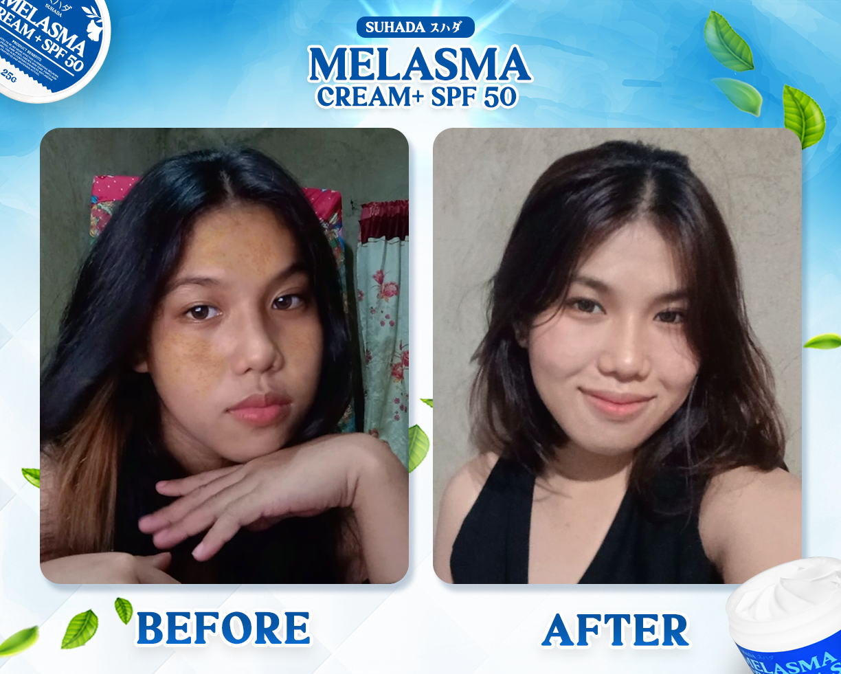 Suhada - Japanese Melasma Cream with SPF 50 25g Removes Melasma, Pekas ...