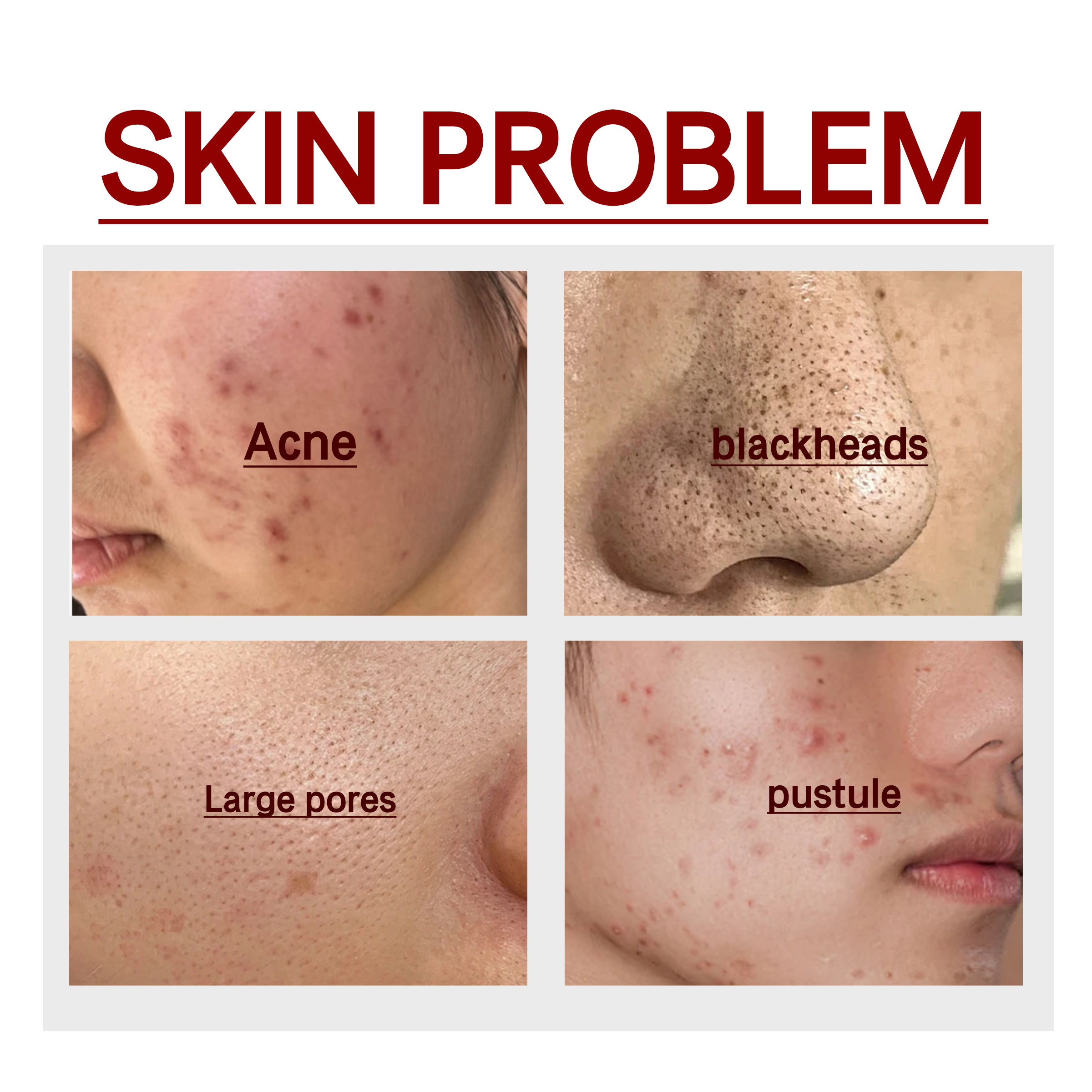 Adapalene Anti-Ance Gel 0.1% Retinol Pimple Pores Acne Remover ...