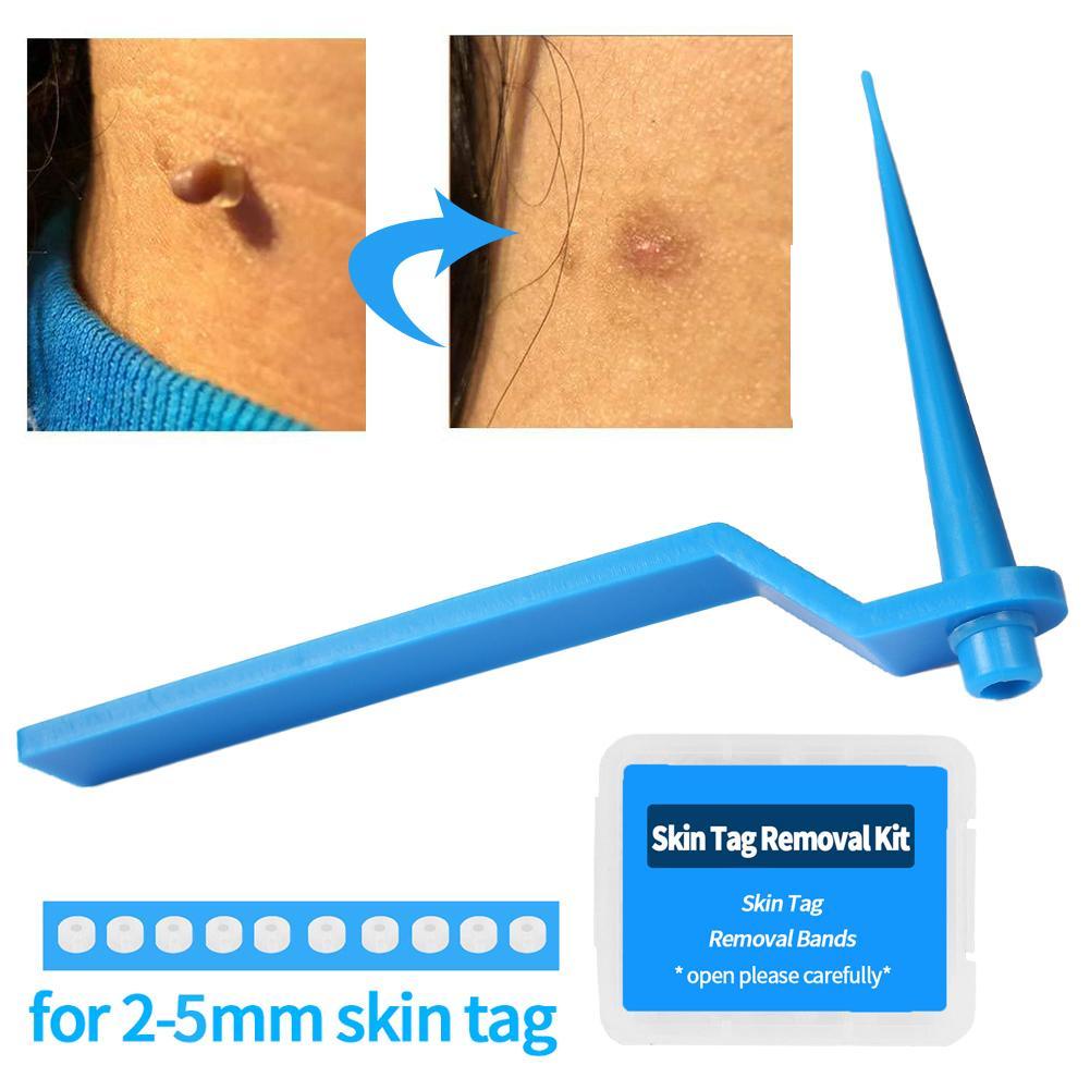 Skin Tag Remover Band Warts Removal Rubber Band Adult Mole Kulugo ...