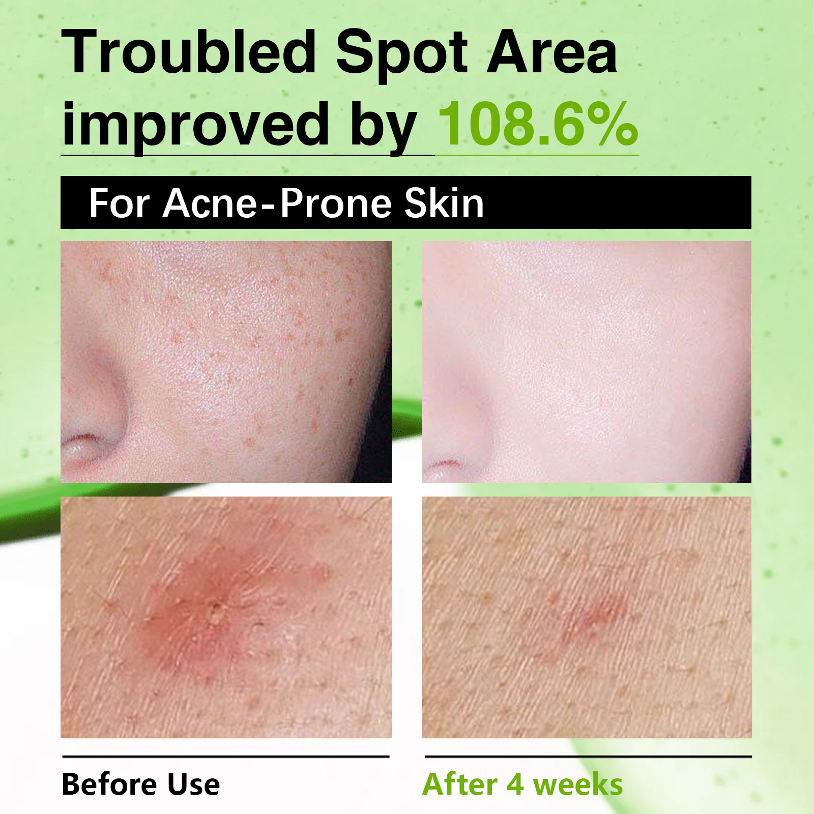 Azelaic Acid 10 Hyaluron Redness Soothing Serum Acne Spot Treatment ...