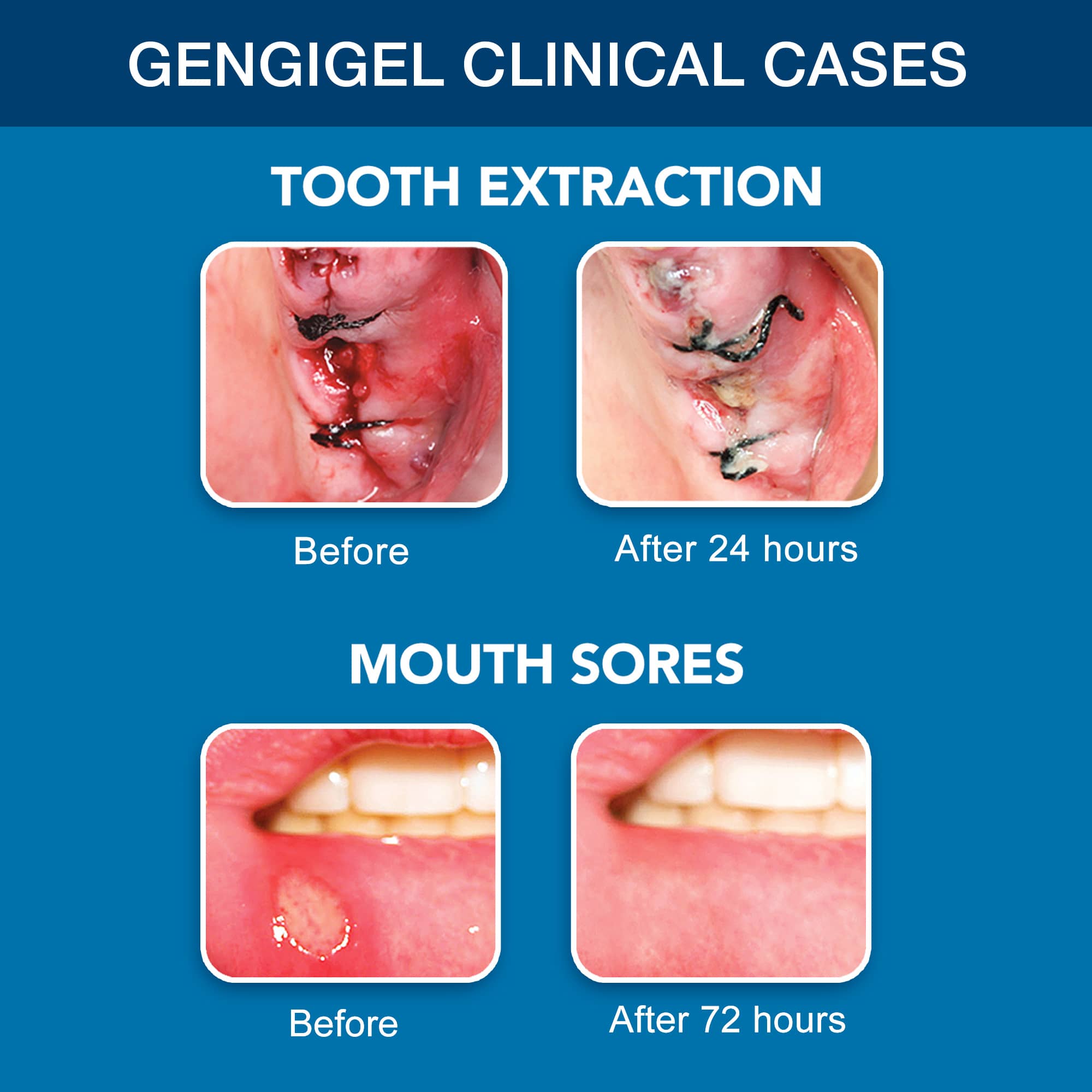 GENGIGEL Sachet (15 sachets) For Wound Healing, Singaw, Mouth Sores ...