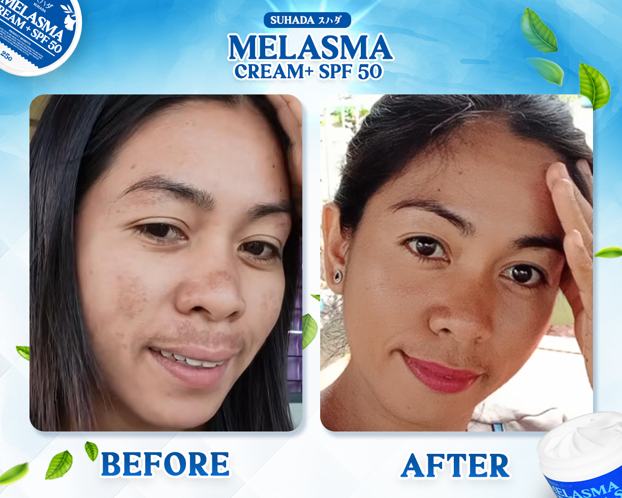 Suhada - Japanese Melasma Cream with SPF 50 25g Removes Melasma, Pekas ...