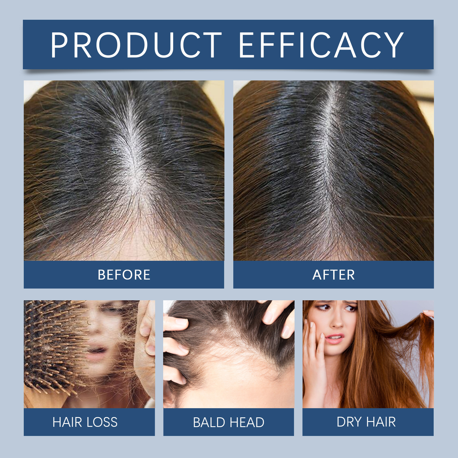 Hoegoa Minoxidil Hair Regrowth Spray 60ml Proven to regrow hair For use ...