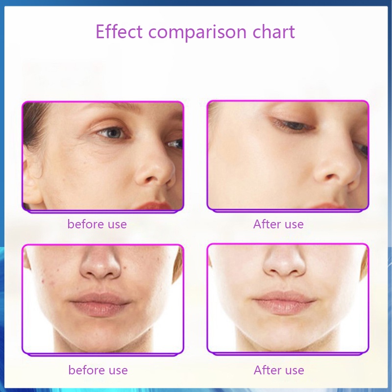 Warts Spot & Mole Removal Portable Home Beauty Equipment Laser Facial ...
