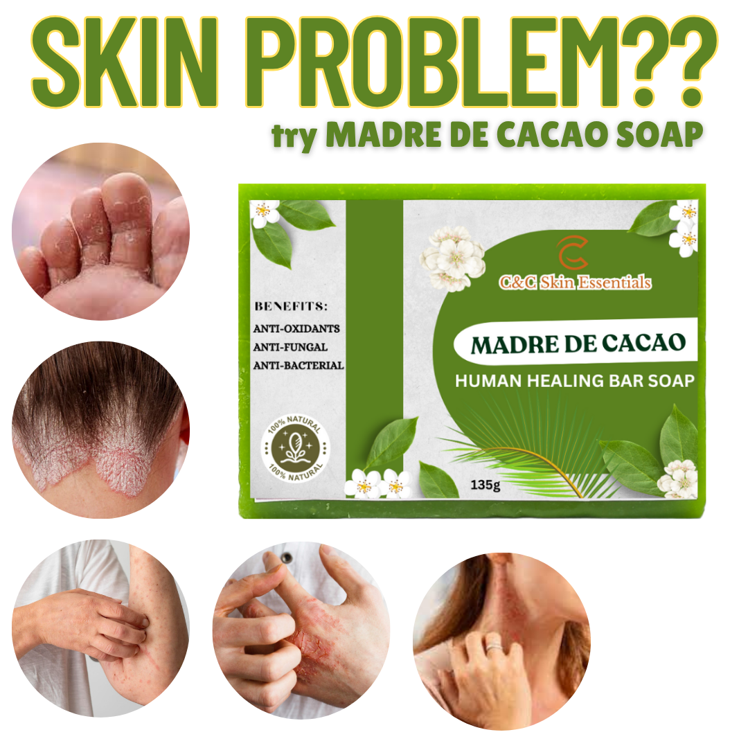 Madre De Cacao Soap for Human Skin Problems: Anti bacterial Soap, Anti ...