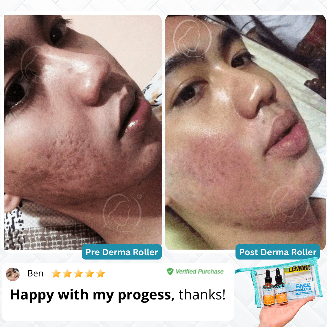 [PROMO] PACKAGE A Dermaroller by Derma Roller Philippines (ORIGINAL ...