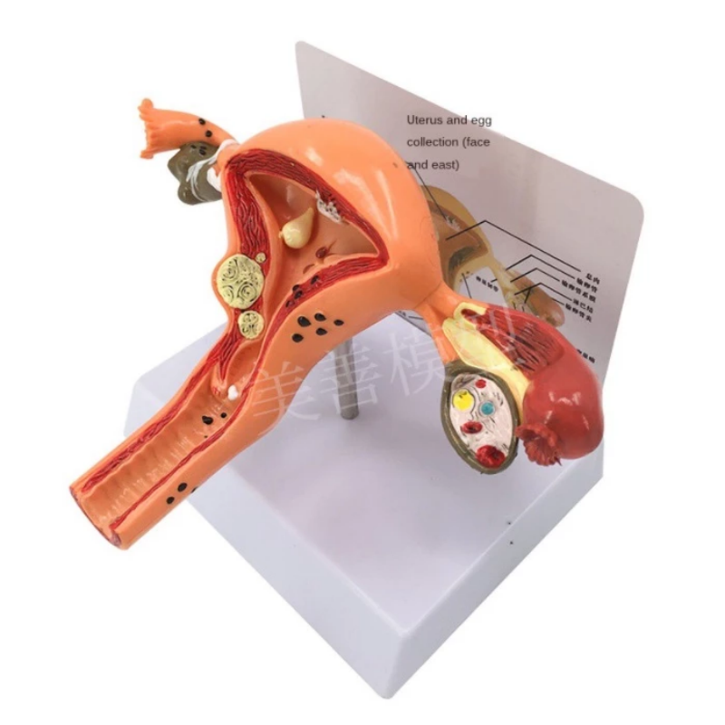 Pathological Uterus Ovary Anatomical Model Anatomy Cross Section Study ...