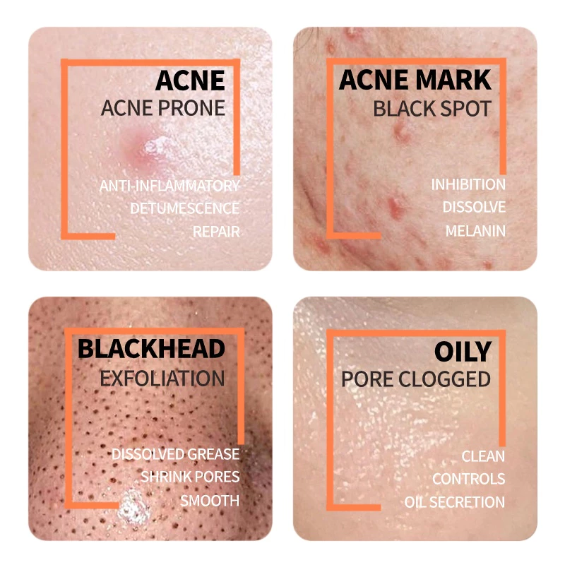 Heart Leaf Soothing Toner Exfoliating Oil Control For Acne And Pimple ...