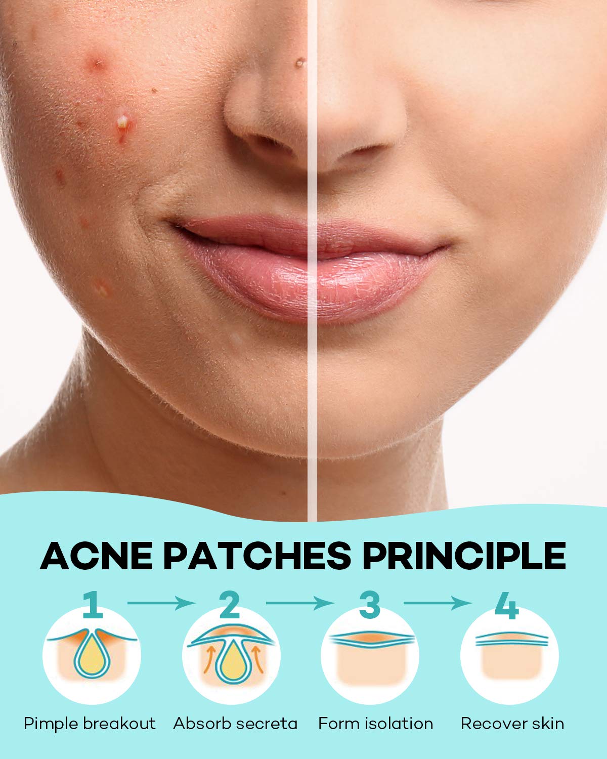 PanOxyl Pimple Patch Acne Treatment Blemish Treatment Patch For Face ...