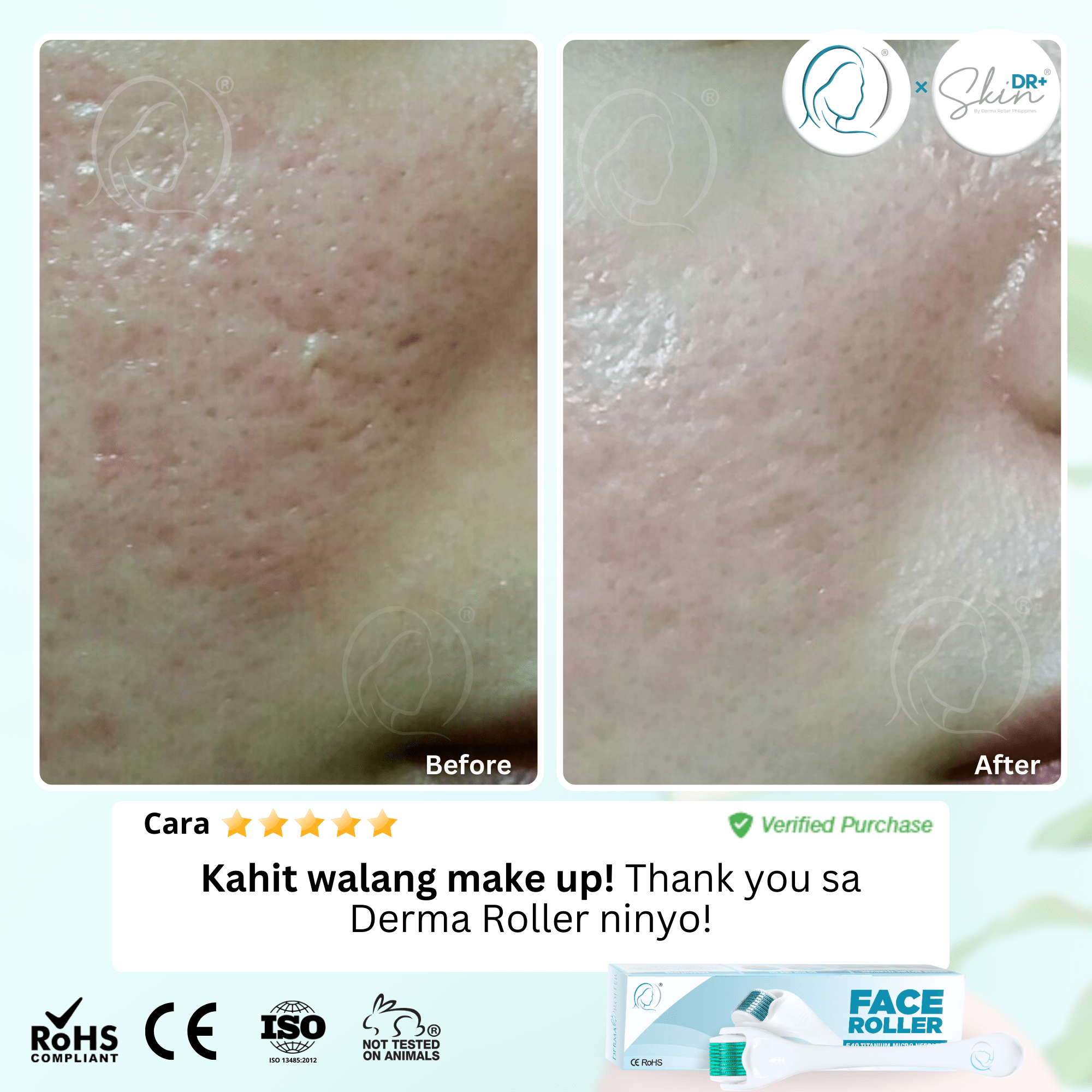 [45% OFF] Original Dermaroller by Derma Roller Philippines For Face and ...