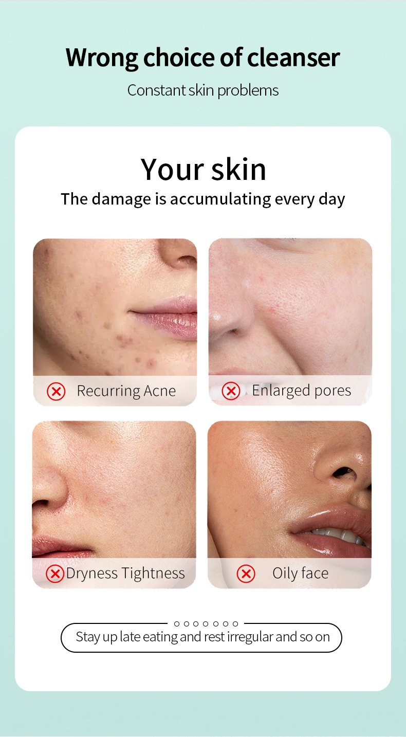 Salicylic Acid Facial Cleanser. Contains amino acids for acne treatment ...