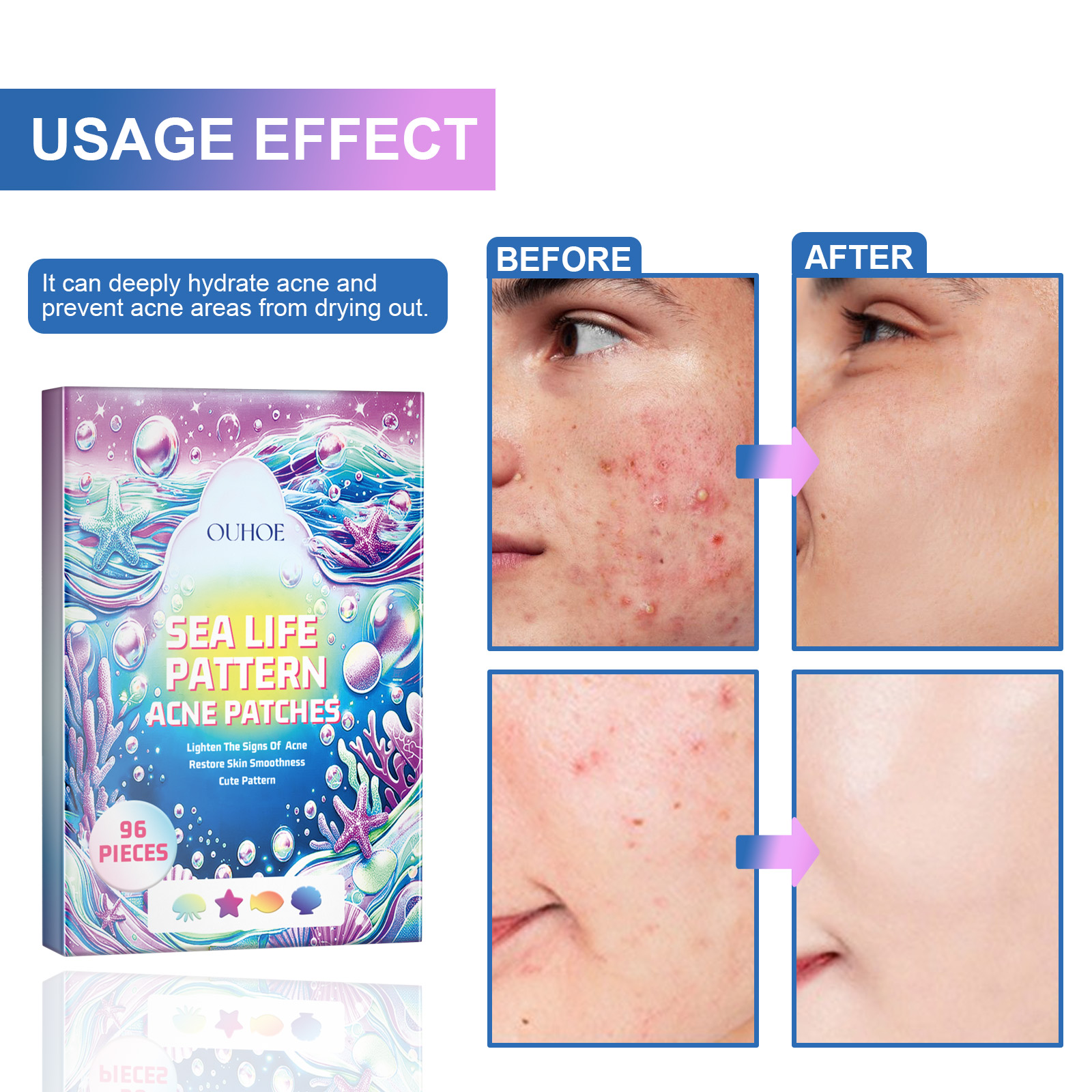 OUHOE Cute colorful acne patches 96pcs Cute Colorful Pimple Acne Sea ...