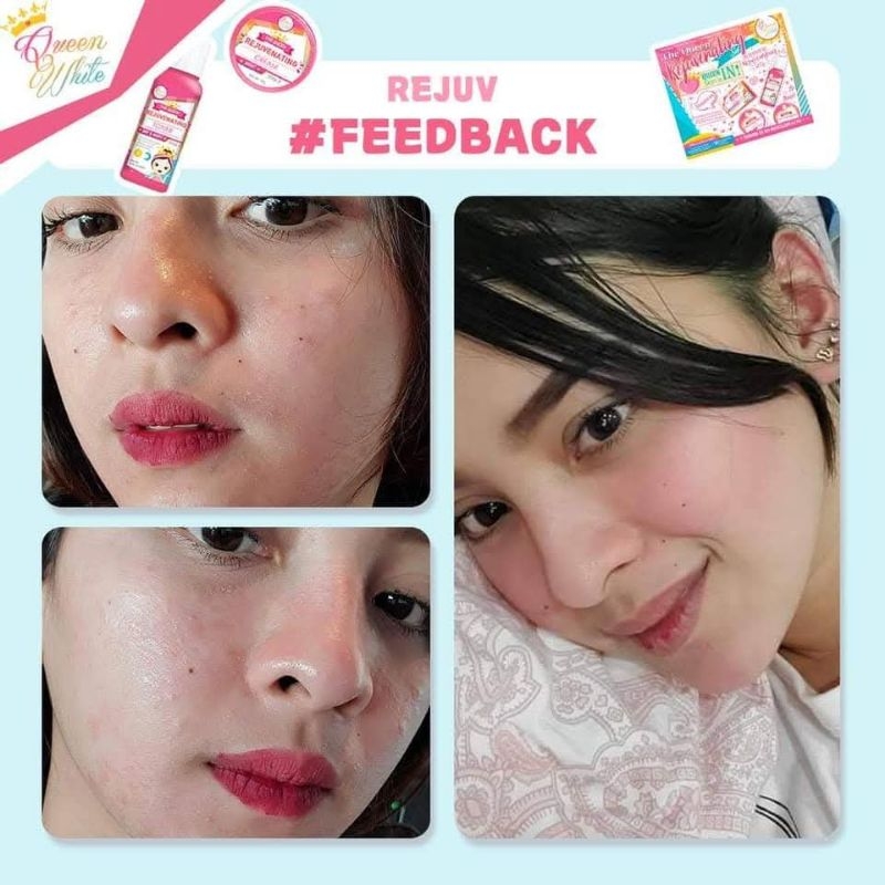 Queen White Rejuvenating Set Acne and Pimple Solution | Shopee Philippines