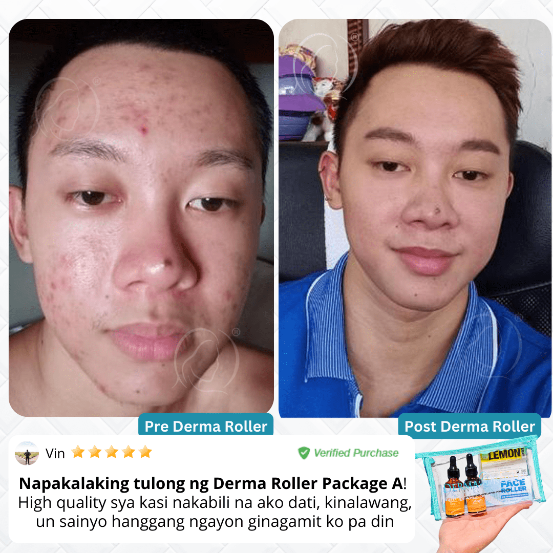 [PROMO] PACKAGE A Dermaroller by Derma Roller Philippines (ORIGINAL ...