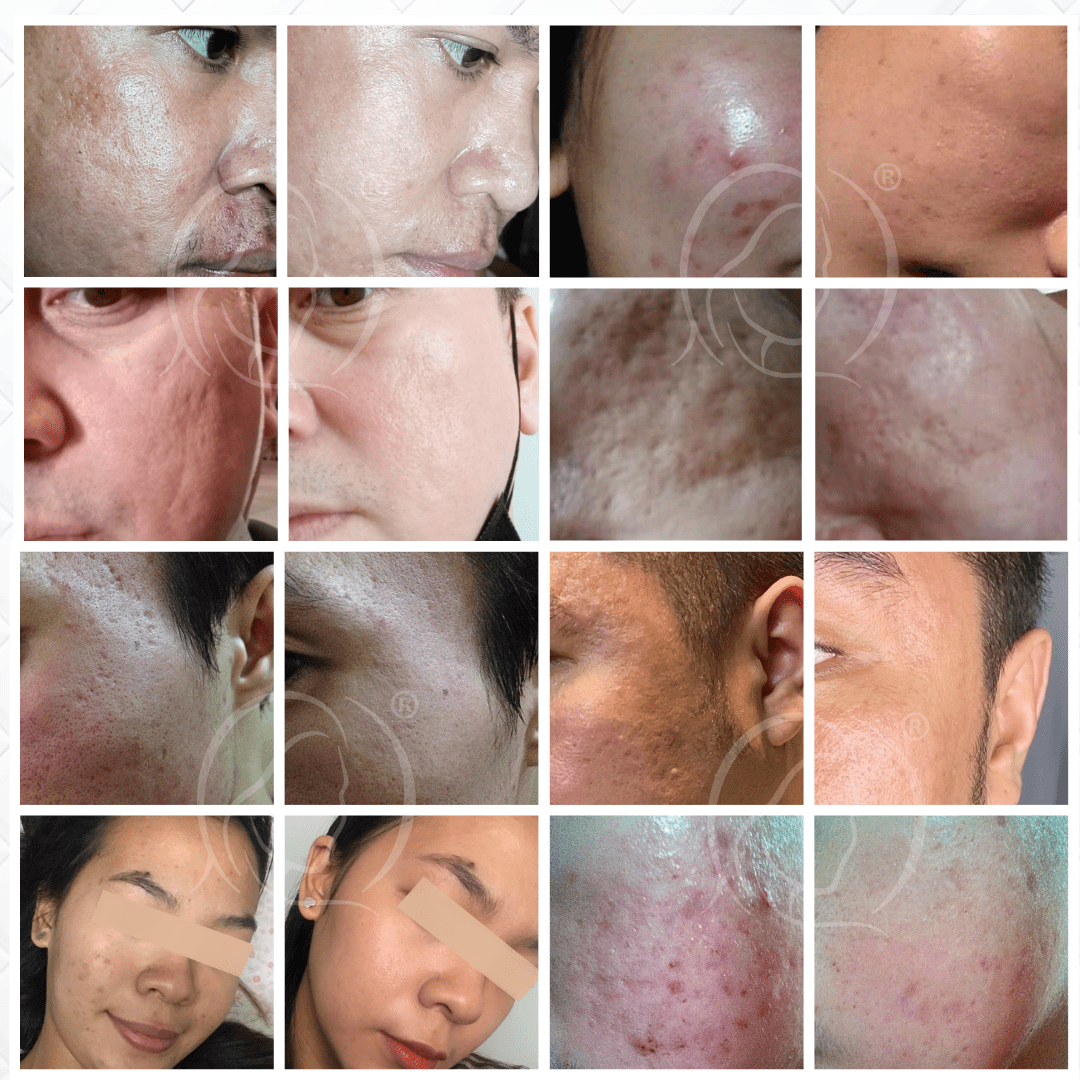 [PROMO] PACKAGE A Dermaroller by Derma Roller Philippines (ORIGINAL ...