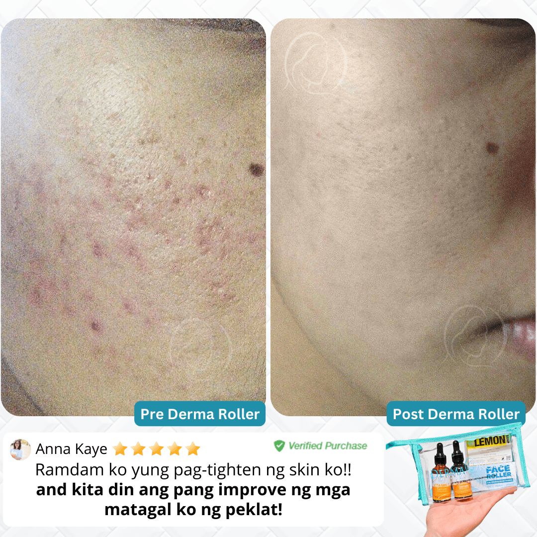 [PROMO] PACKAGE A Dermaroller by Derma Roller Philippines (ORIGINAL ...