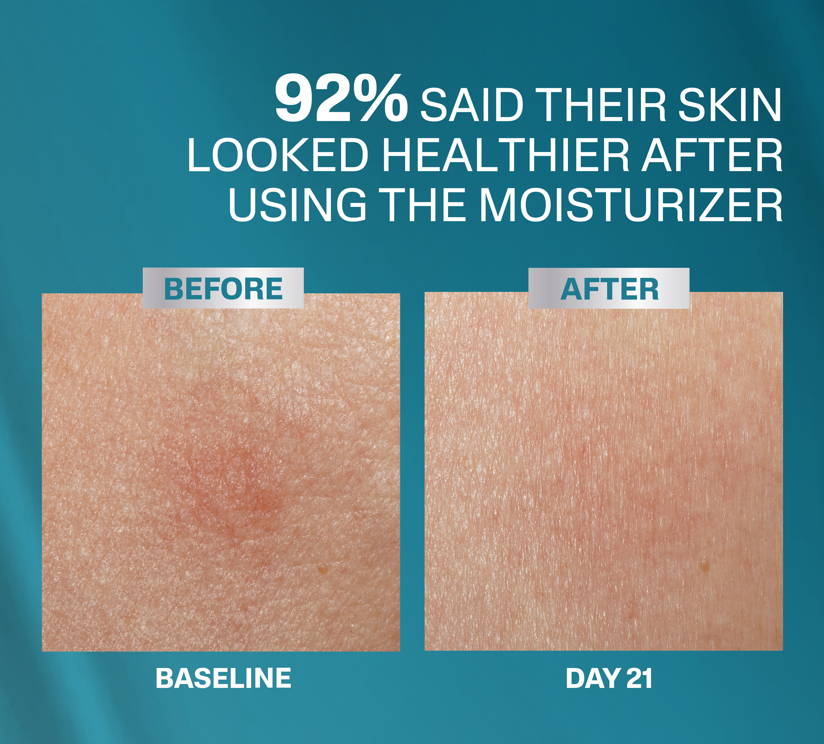 Cetaphil Pro Ad Derma Skin Restoring Moisturizer 295ml (For Eczema ...