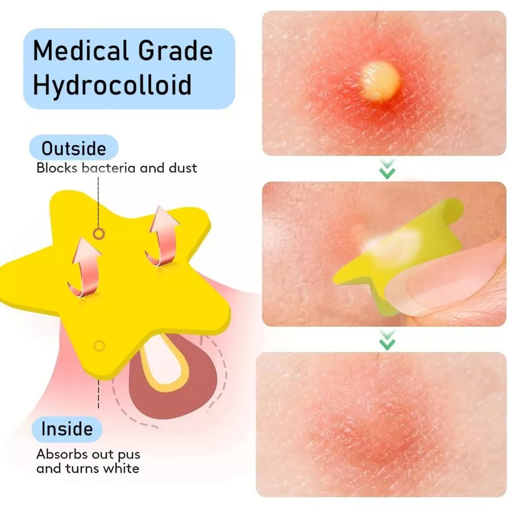 360pcs Hydrocolloid Colorful Acne Patch Mild Acne Pimples Patches ...