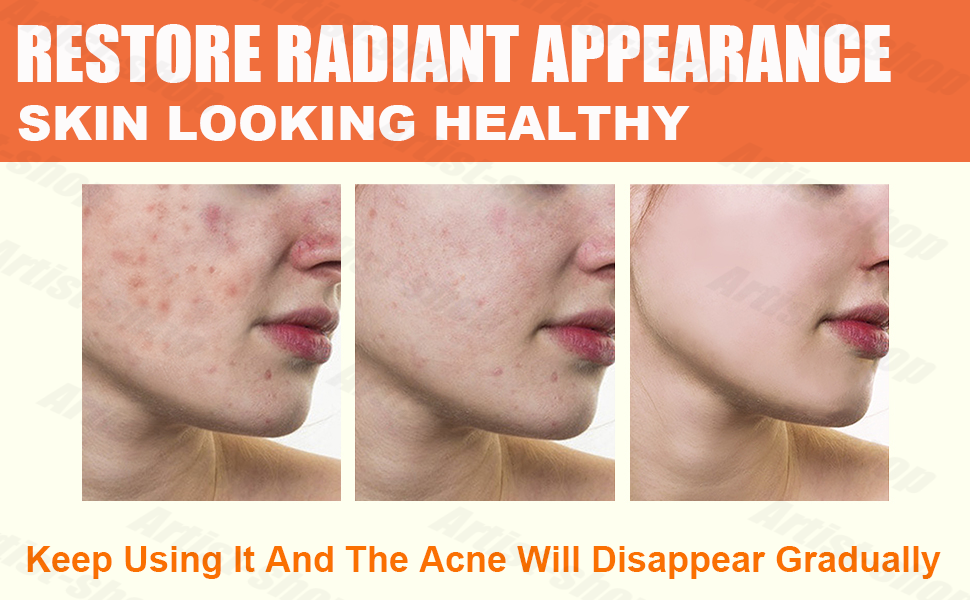Pimple acne remover Effective Pimple Treatment Helps Calm Red Angry ...