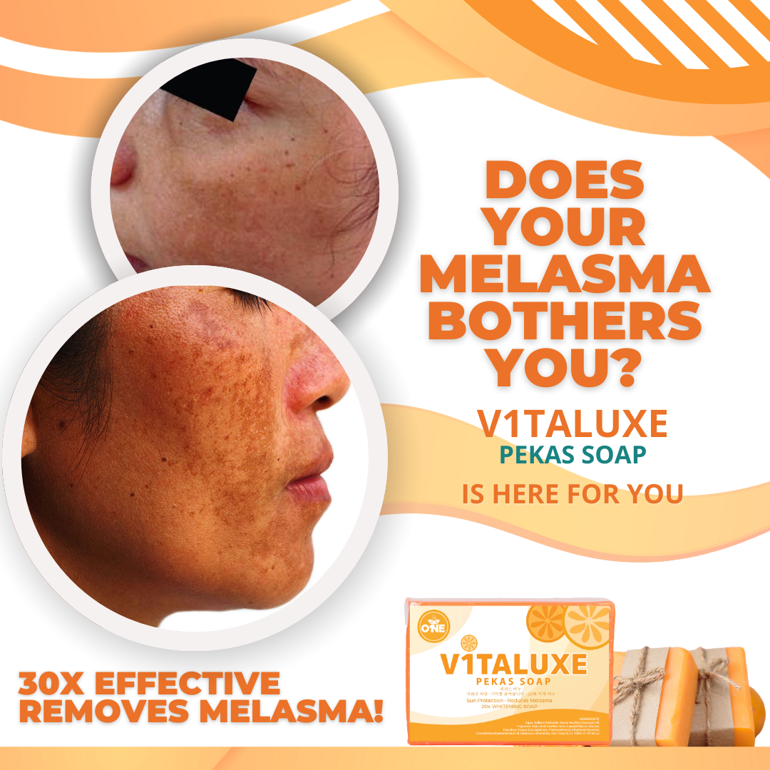V1taluxe Melasma Pekas Soap-Dark Spots,Melasma,Pekas,Hyperpigmentation ...