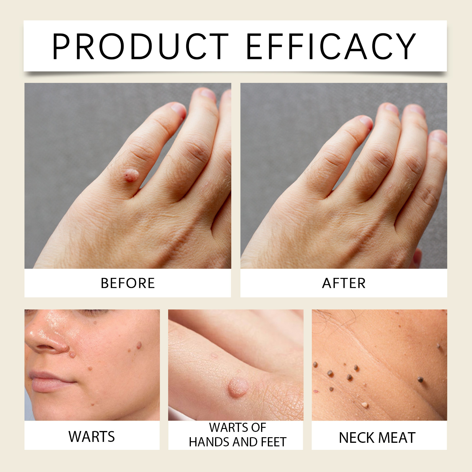 Ximonth Bee Venom Mole And Wart Care Cream 60g Mole Remover Skin Tag ...