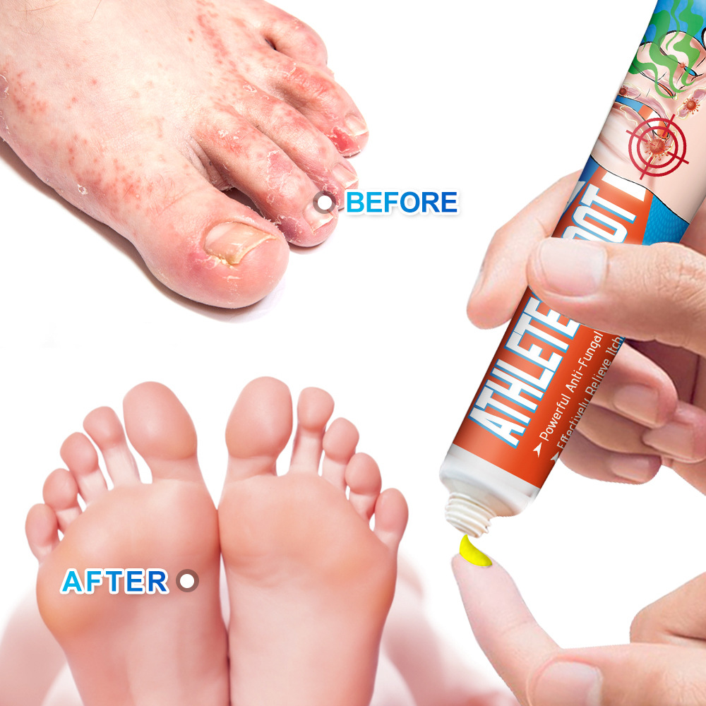 Foot Anti-fungal Athlete's Foot Cream Deodorant Cream Anti-Itch Odor ...