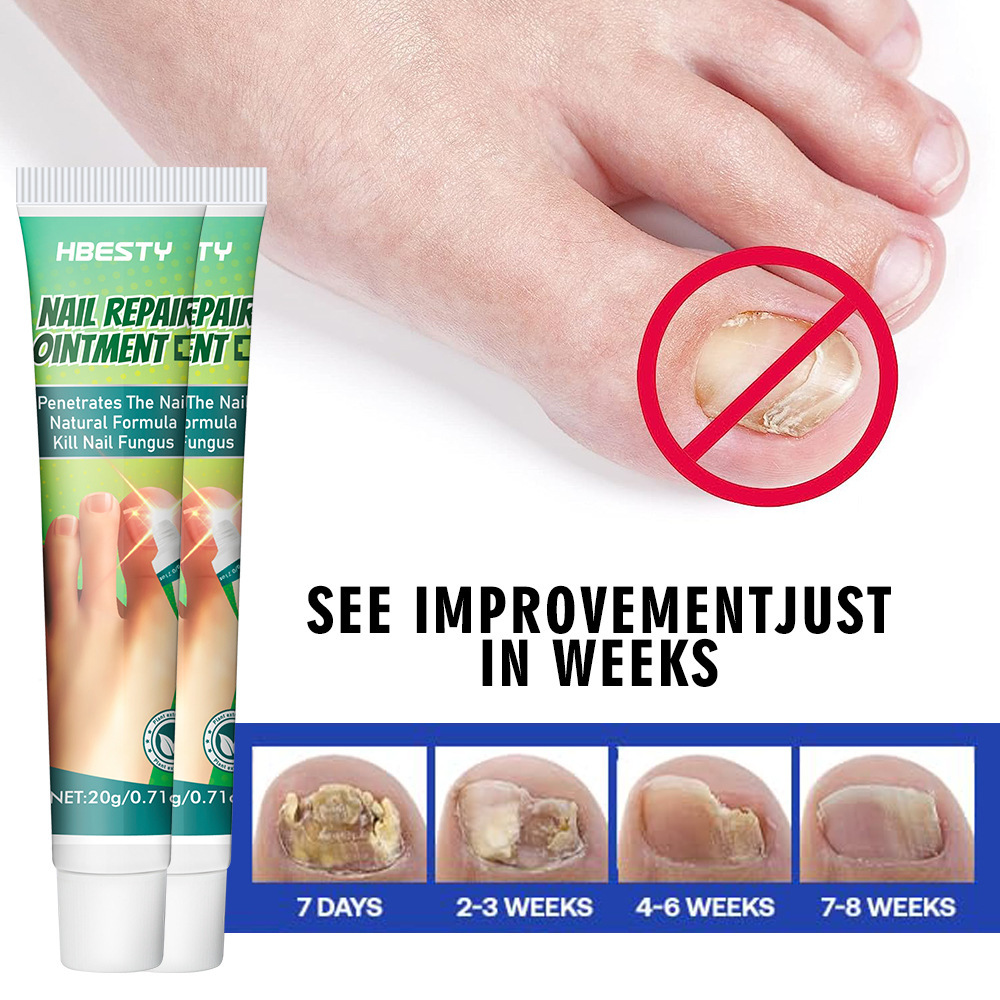 Nail Treatment Paronychia Remove cream Fungal Onychomycosis Nail Repair ...