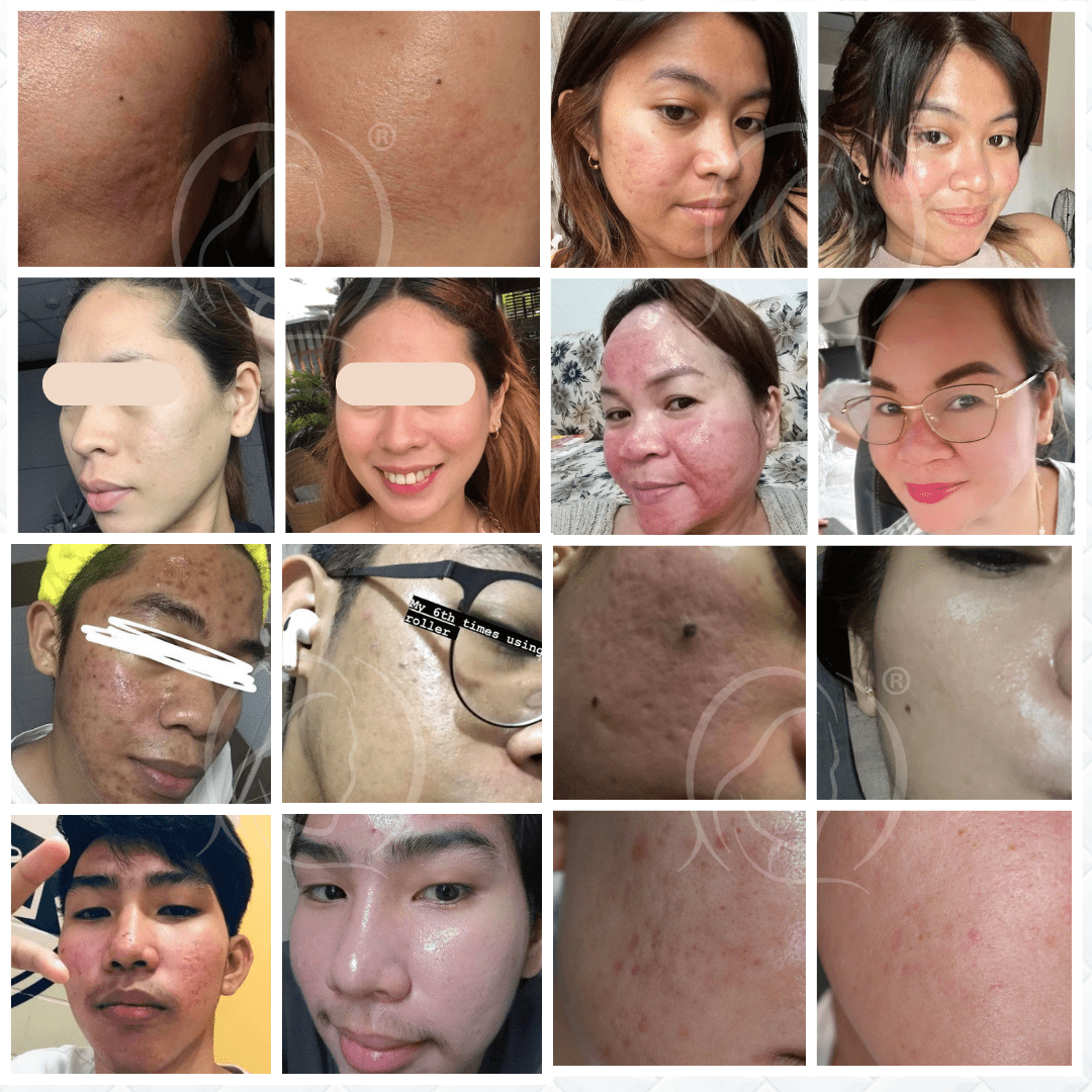 [PROMO] PACKAGE A Dermaroller by Derma Roller Philippines (ORIGINAL ...