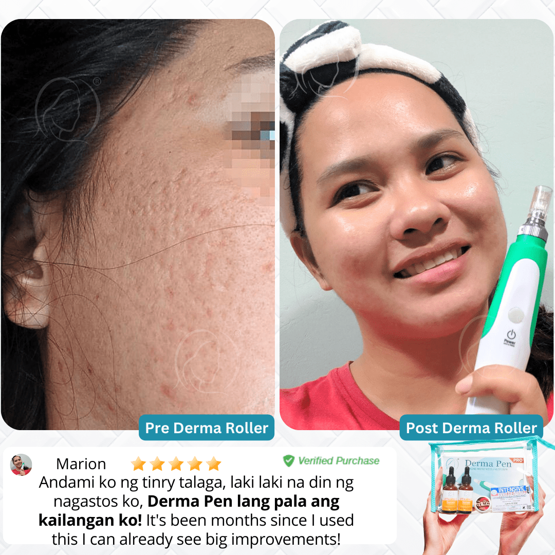 [PROMO] Derma Pen PACKAGE [PRO | MAX] by Derma Roller Philippines ...