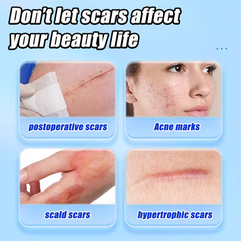 SOL LORA 30g pimple remover cream keloid scar cream remover original ...
