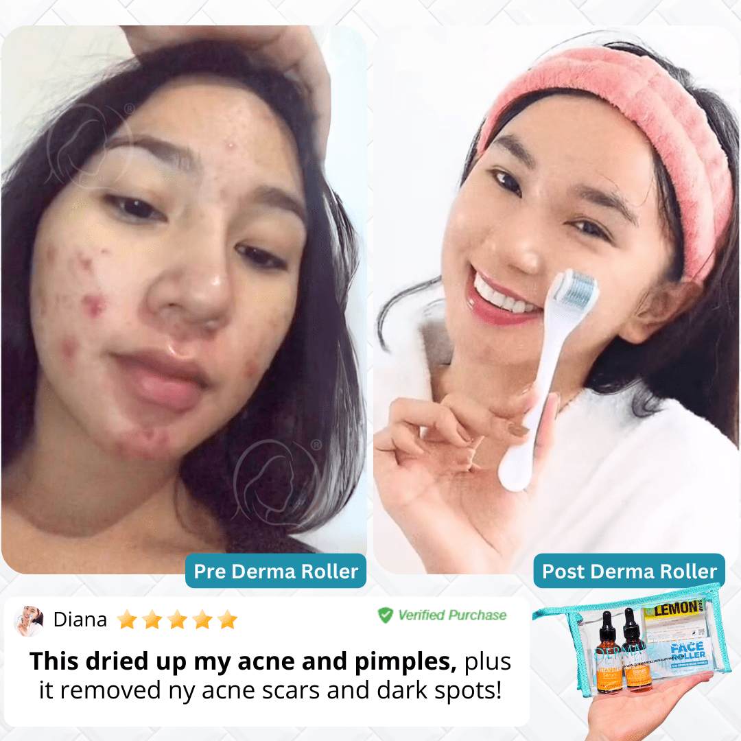 [PROMO] PACKAGE A Dermaroller by Derma Roller Philippines (ORIGINAL ...