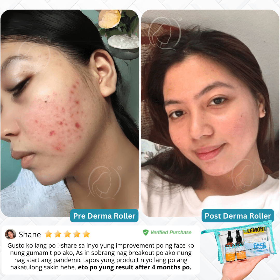 [PROMO] PACKAGE A Dermaroller by Derma Roller Philippines (ORIGINAL ...