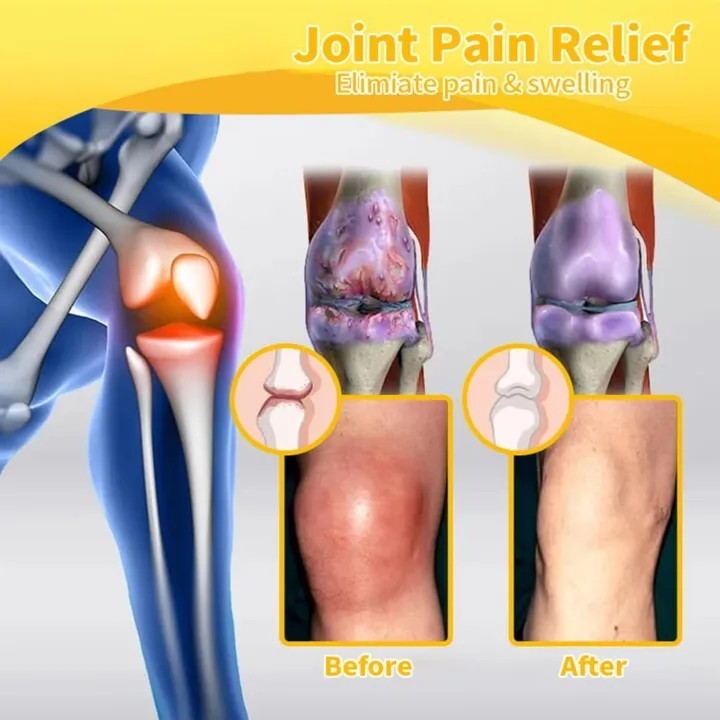 Joint soothing cream treats joint inflammation, repairs synovitis and ...