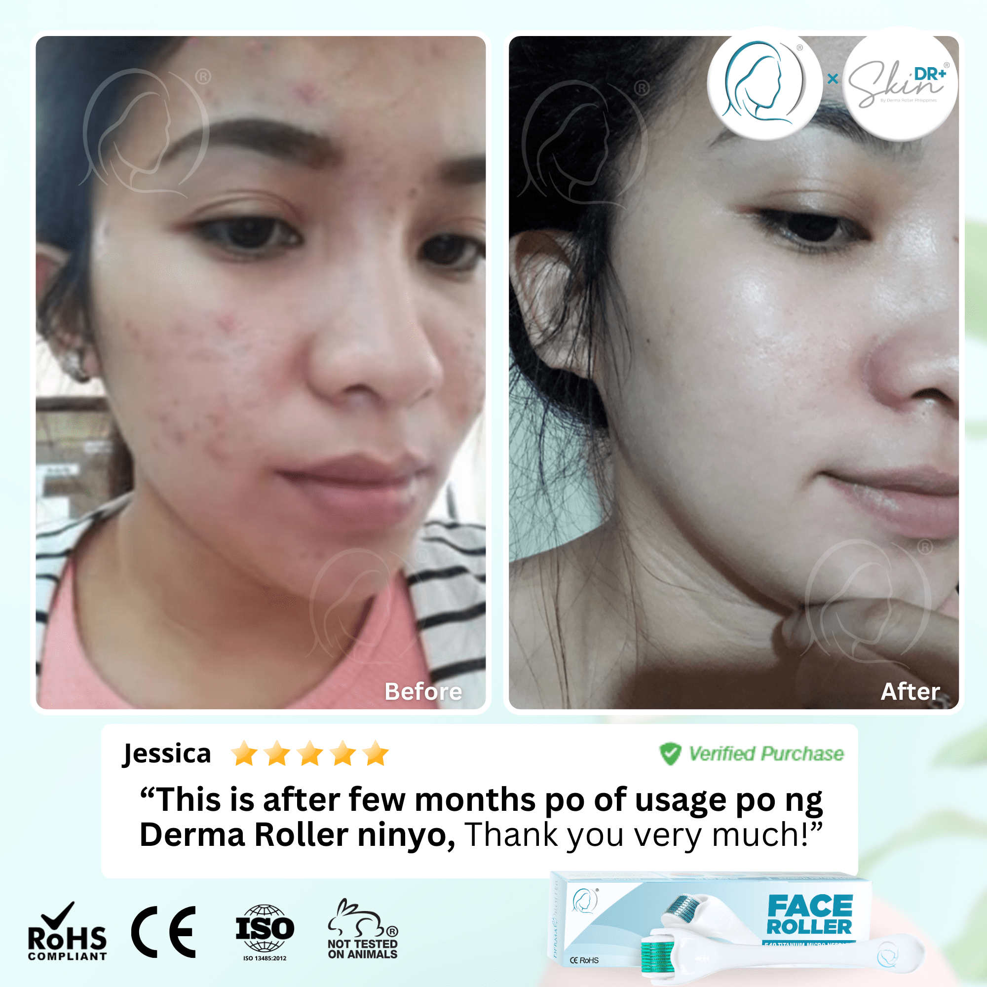 [45% OFF] Original Dermaroller by Derma Roller Philippines For Face and ...