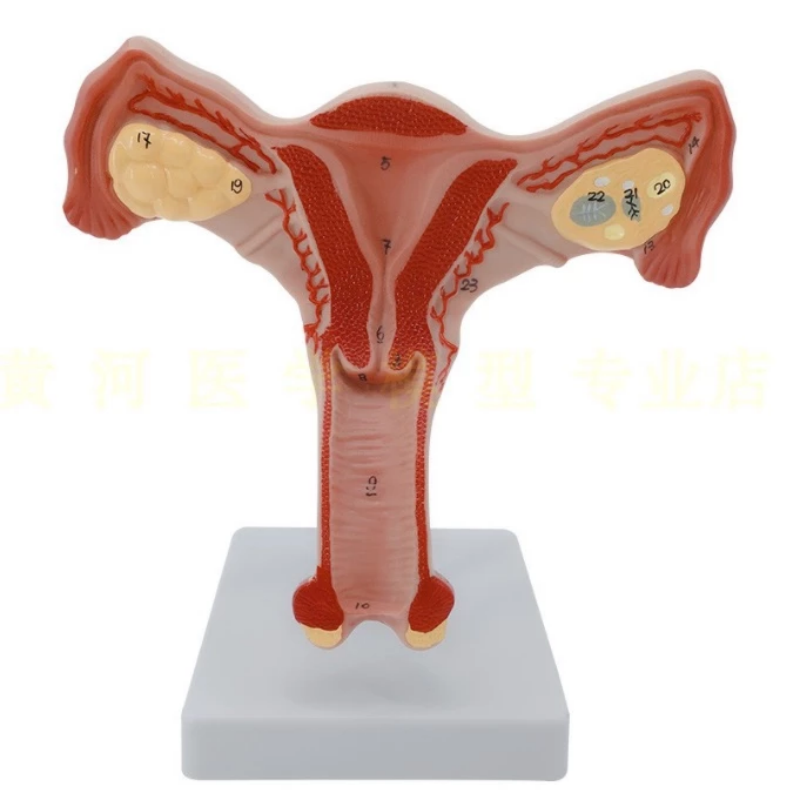 Pathological Uterus Ovary Anatomical Model Anatomy Cross Section Study ...