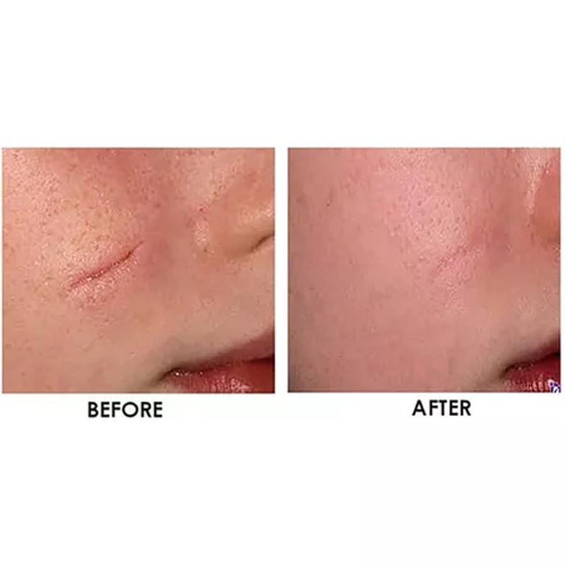 Contractubex The Scar gel that makes the Difference 30g From Germany ...