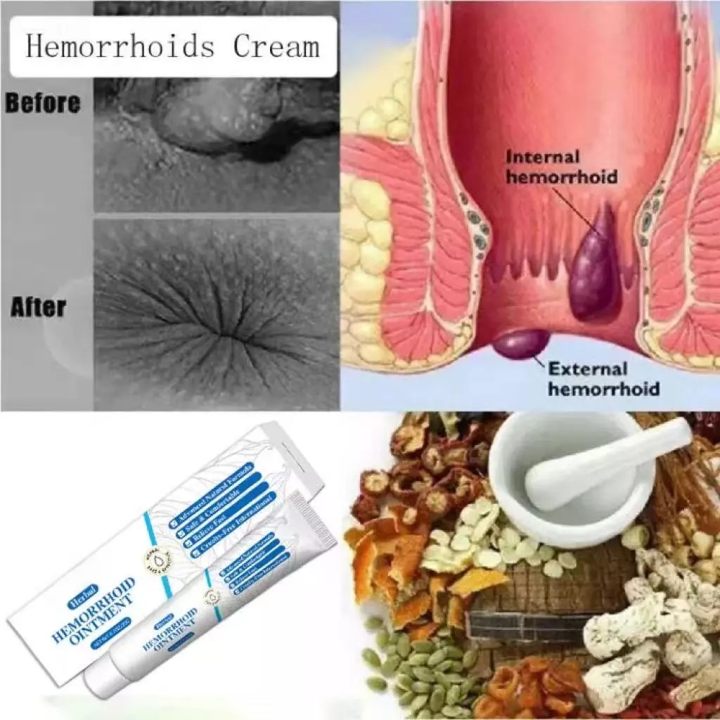 External Hemorrhoids Ointment almoranas ointment Perianal Eczema ...