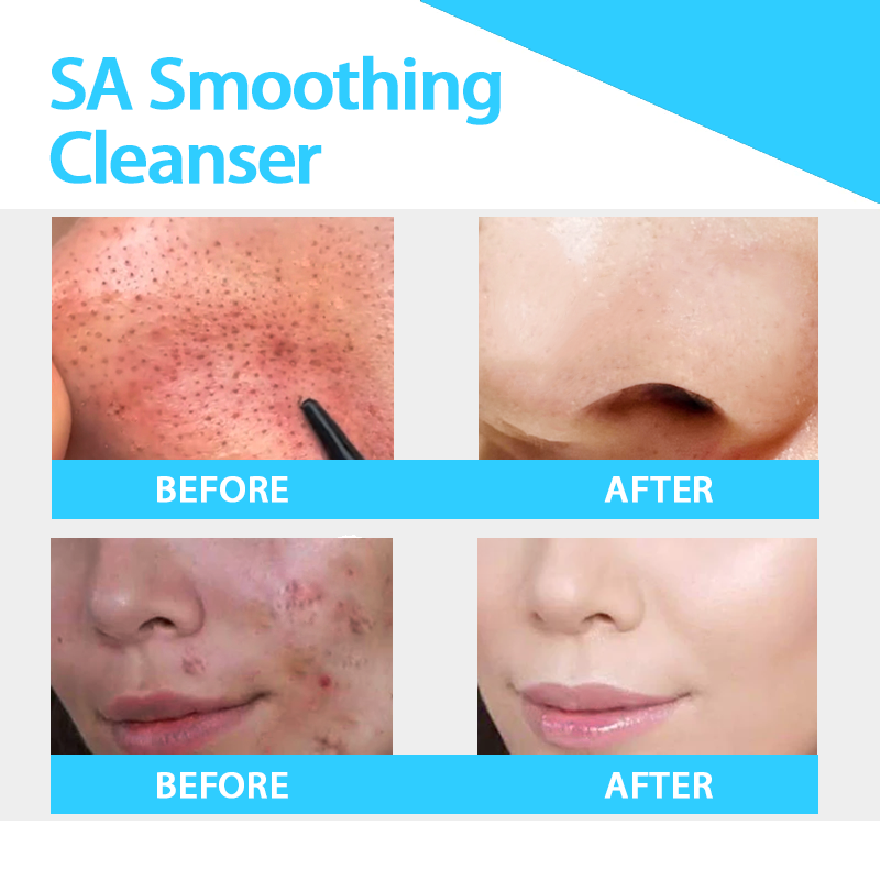 SA Smoothing Cleanser + Cream Set |Salicylic Acid Duo for Gentle ...