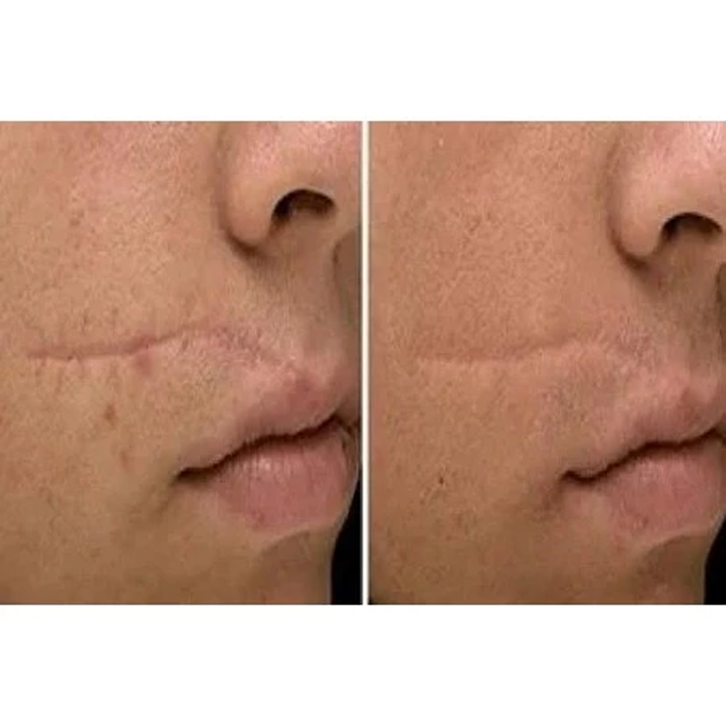 Contractubex The Scar gel that makes the Difference 30g From Germany ...