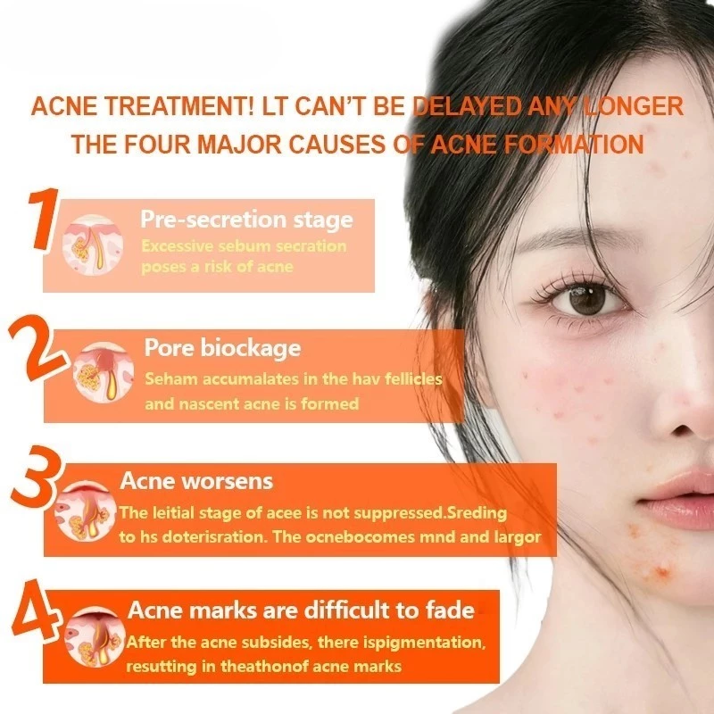 SKINOREN 20% Acne Cream 30g Azelaic Acid Desalination Acne And Dark ...